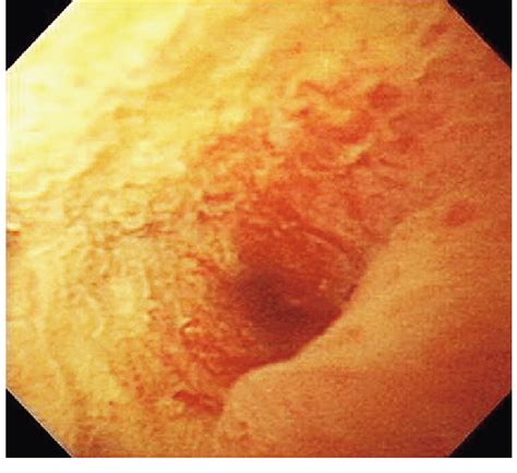 Hilar Cholangiocarcinoma Showing Peripheral Infiltrative Growth Type