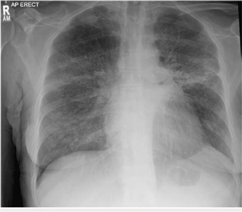 Cxr Note The Bilateral Diffuse Fine Reticular Opacities Seen In Pcp