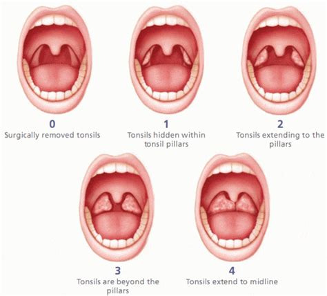 Tonsil Size Chart ~ The Autism Cafe