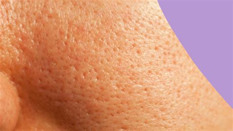 Clogged Pores Causes And How To Treat Them Asap Glamour Uk