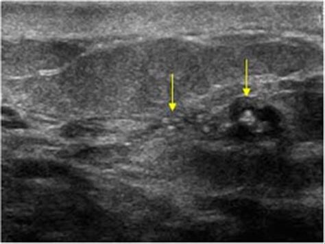Breast And Axilla 5 2 Malignant Breast Lesions Case 5 2 13 Carcinoma In Situ And