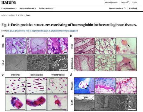 Histology Hedy Pathologist Hemepath Pedipath Pathology Miguel
