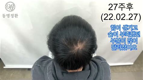 30대 직장 막내의 헤어스타일 변화 동명정환섭취후기 Youtube