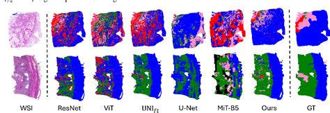 Bridging Classification And Segmentation In Osteosarcoma Assessment Via