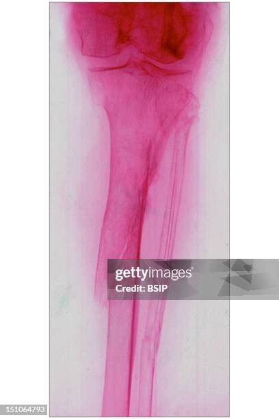 Pathologic Fracture Photos And Premium High Res Pictures Getty Images