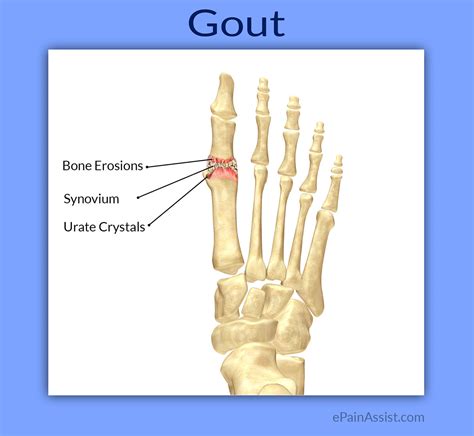 Gout Treatment Causes Symptoms Prevention Diagnosis