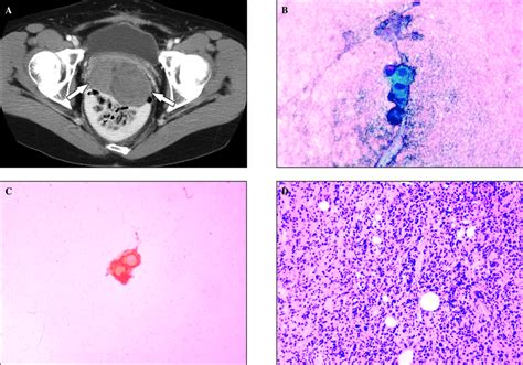 A Contrast Enhanced Ct Scan Shows A Large Heterogeneous Moderately Download Scientific