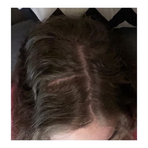 Literally Have A Second Part Forming Aga Hairloss Rfemalehairloss