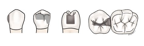 Class Ii Amalgam Restoration My Dental Key