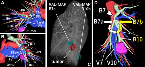 Uniportal Thoracoscopic Bisegmentectomy Of Medial And Posterior Basal