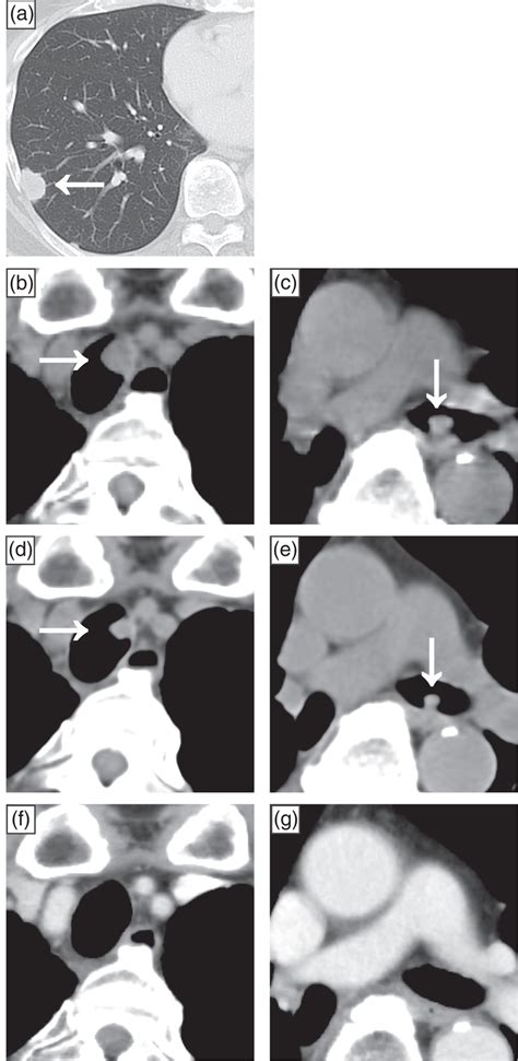 Before Surgery Computed Tomography Ct Showed A Nodule In The Lower Download Scientific