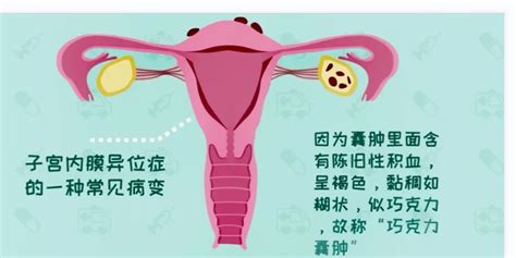 今日科普 卵巢巧克力囊肿必须要手术吗？