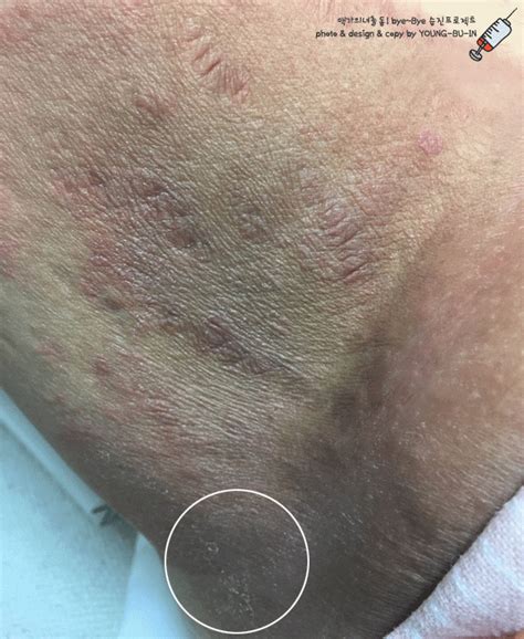 사타구니 습진 나랑 놀자 습진아~ 덤뵤 Day 1 네이버 블로그