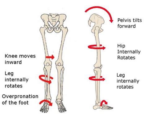 Anterior Pelvic Tilt And Flat Feet