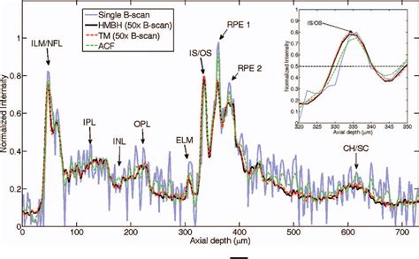 Figure 4 From Speckle Reduction In Optical Coherence Tomography Imaging By Affine Motion Image