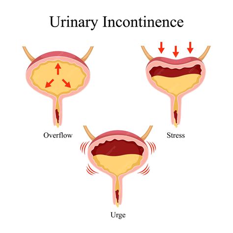 Premium Vector Human Urinary Incontinence Design Vector