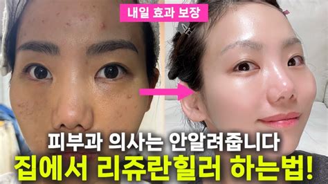 광고 Only 홈 케어 딱 10분 홈케어로 내일 당장 피부좋아집니다 여드름 속건조 유수분밸런스 다 잡아주는 루틴 Pdrn 리쥬란힐러 앰플추천 Youtube