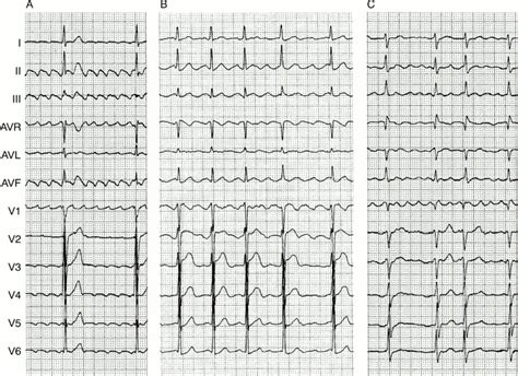 History Of Atrial Flutter Icd 10 Dikisnet