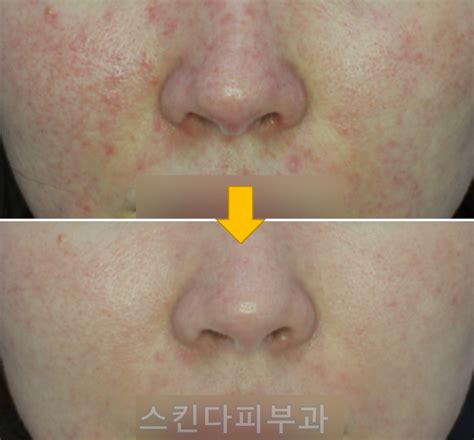 주사피부염 홍조 레이저치료 효과비교브이빔시너지엑셀브이ddr레이저 네이버 블로그