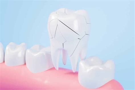 What Does A Crack In The Tooth Root Mean Elite Endodontics Of Nh