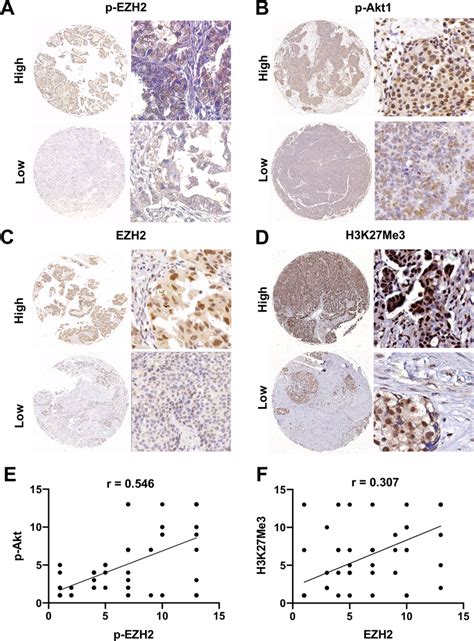 General Expression Of Ezh2h3k27me3 And Pakt1pezh2 In Ovarian Cancer