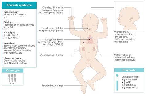 Edwards Syndrome Trisomy 18 Genetic Condition Symptoms 60 Off