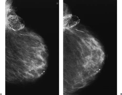 Eggshell Calcification