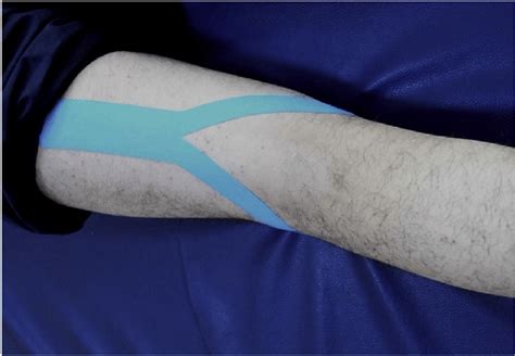 Kinesio Tape Hamstring Muscle Technique Download Scientific Diagram