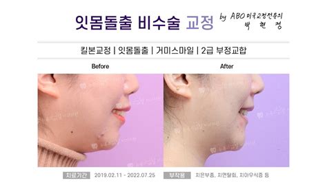 해운대교정치과 뉴욕스마일치과 잇몸돌출 비수술교정킬본교정잇몸돌출거미스마일2급부정교합 Banda 해운대돌출입교정해운대재교정치과해운대교정전문의 Youtube