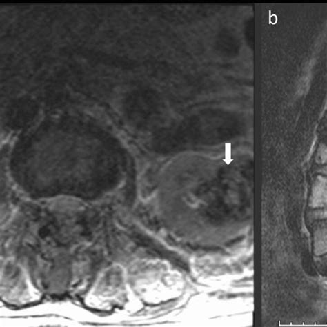 A 68 Year Old Female Patient Showing Dilated Cbd With Distal Cbd Stone