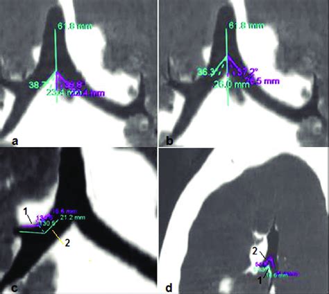 Measurement Of Right And Left Subcarinal Angle A Right And Left