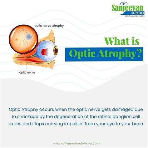 What Is Optic Atrophy Optic Atrophy Occurs When The Optic By