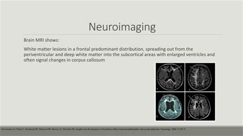 Hereditary Diffuse Leukoencephalopathy With Axonal Spheroids Ppt
