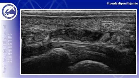 Jamie Bie Rdms Rvt Rmsks Auf Linkedin Bursa Bursitis