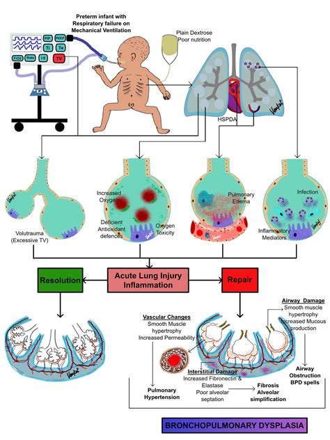 Systemic Hypertension In Infants With Bronchopulmonary Dysplasia Vqgvva