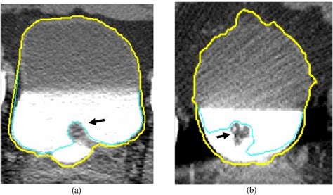 Bladder Segmentation Using Class With And Without Mgr A Class Download Scientific Diagram
