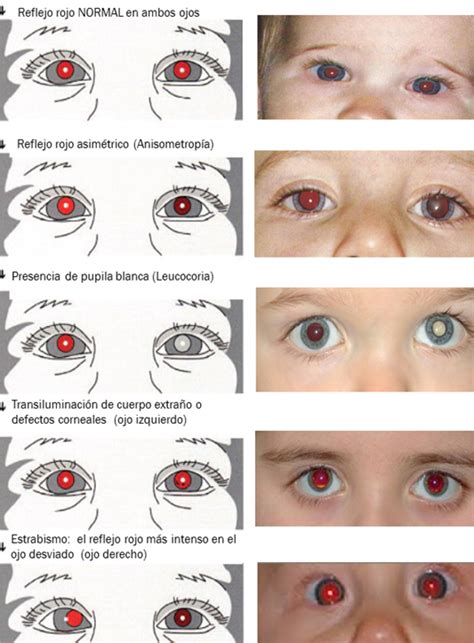 Interpretación Anatomia Ocular Anatomía Del Ojo Material De Enfermeria