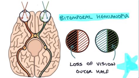 Neuro Exam Flashcards Quizlet Neuro Exam Flashcards Quizlet
