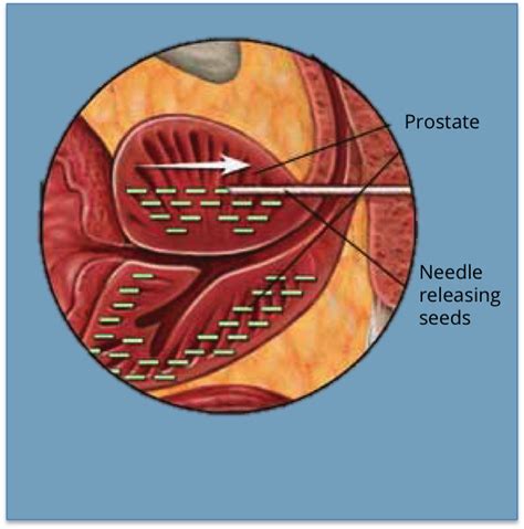 Education Center Prostate Cancer Treatment Options Hifu Prostate Services