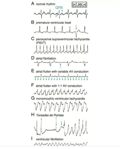 Heart Rhythms Medizzy