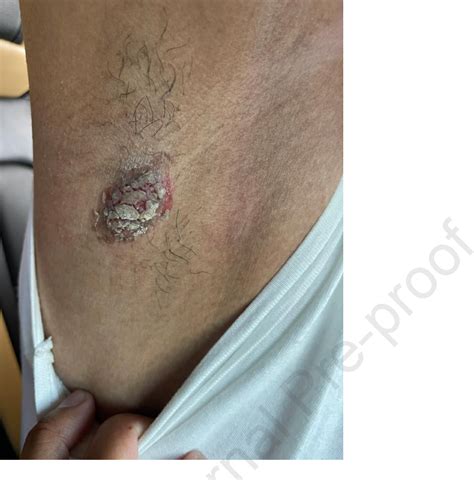 Figure 1 From New Onset Pemphigus Vegetans And Pemphigus Foliaceus After Sars Cov 2 Vaccination