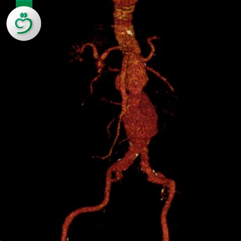 За първи път в България съдови хирурзи от „Софиямед“ спасиха мъж с аневризма на аортата чрез