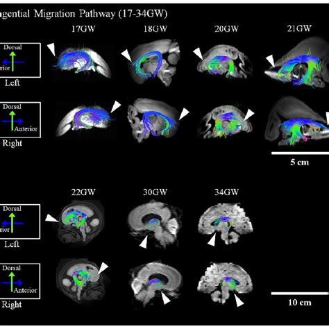 Tangential Migration Pathways Tractography At Representative Ages Of Download Scientific