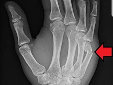 Л Нанжид Сээрний яс хугарах нь хэнд ч хамаагүй үр өгөөжгүй Харин тухайн хүний өөрийнх нь яс