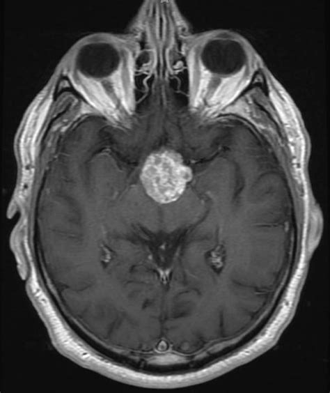 Pituitary Macroadenoma Neuro Mr Radiology Case Studies Ctisus Ct