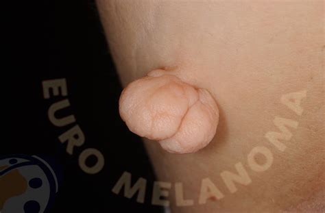 Pedunculated Skin Polyp