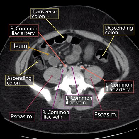 Gross Anatomy Glossary Axial Abdominal Ct Ditki Medical And Biological Sciences