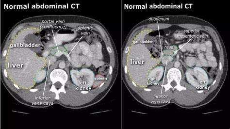Liver Segment Anatomy Ct Scan Pptx