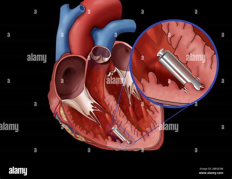 Leadless Pacemaker Illustration Stock Photo Alamy
