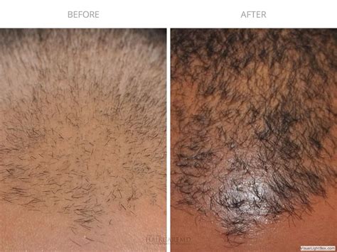 PRP Before And After Photos HairCareMD Hair Restoration Surgeons